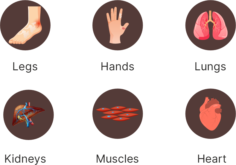 Systemic Sclerosis Scleroderma Dr Urk Rao